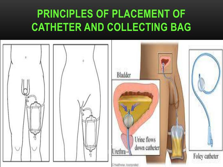 How To Wear A Belly Bag Catheter At Frederic Edith Blog