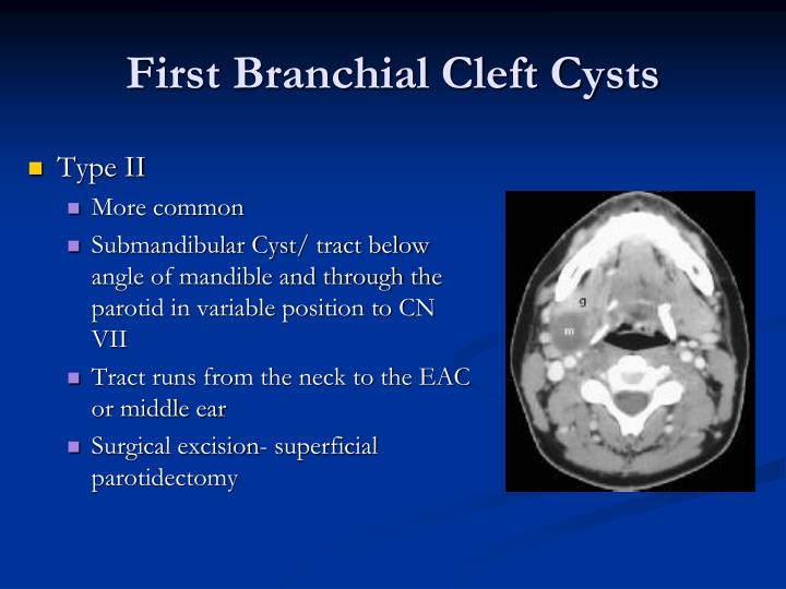 Branchial Cleft Cyst Causes Types Signs Symptoms Diag