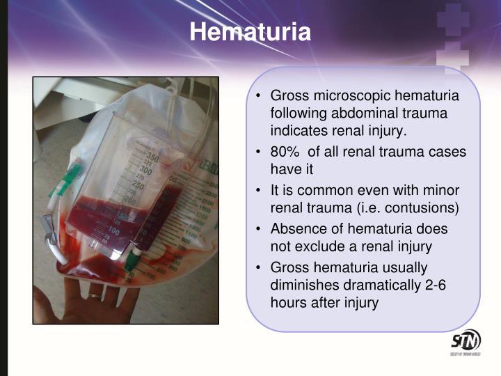 Co To Jest Hematuria Idiopatyczna Objawy Przyczyny I The Best Hot Sex Picture