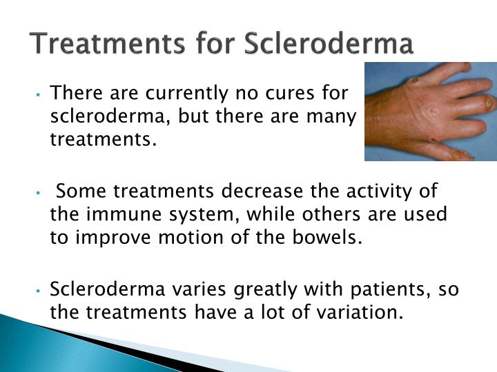 Ppt Scleroderma Powerpoint Presentation Id 2583575