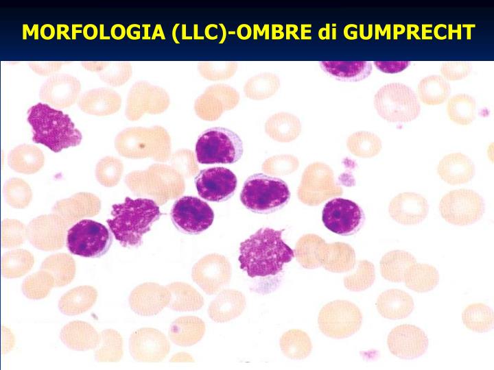PPT - LEUCEMIA LINFATICA CRONICA PowerPoint Presentation - ID:3496144 PPT - LEUCEMIA LINFATICA CRONICA PowerPoint Presentation - ID:3496144
