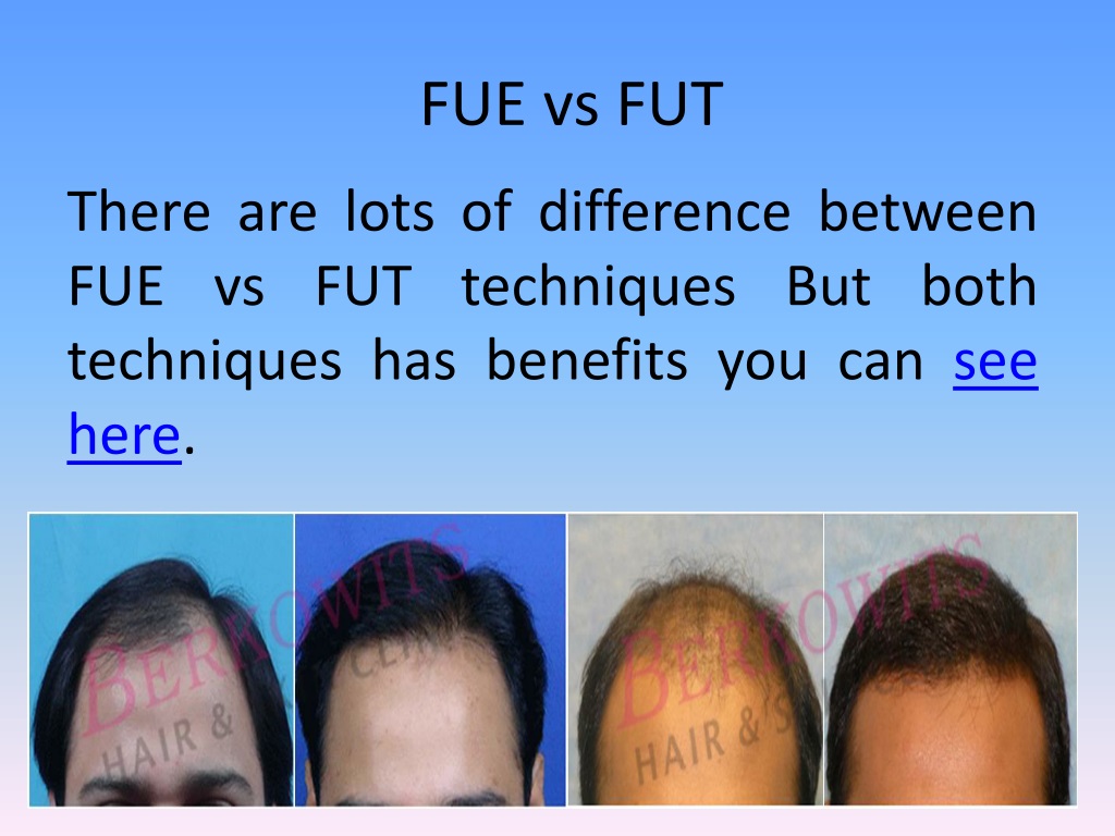 PPT - Genuine Hair Loss Clinic in Delhi PowerPoint Presentation, free ...