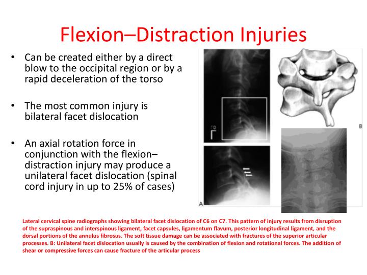 PPT - Cervical Spine Injuries in the Athlete PowerPoint Presentation ...