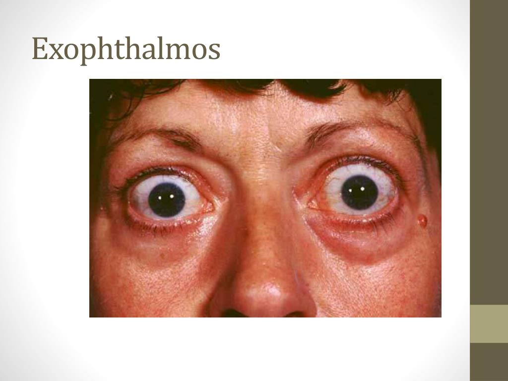 PPT - BISMILLAHIRRAHMANIRRAHIM P HYSICAL EXAMINATION OF THYROID DISEASE PowerPoint Presentation ...