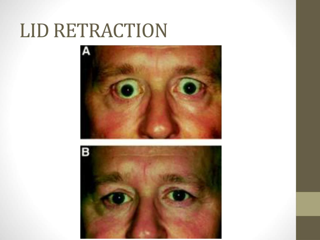 PPT - BISMILLAHIRRAHMANIRRAHIM P HYSICAL EXAMINATION OF THYROID DISEASE ...