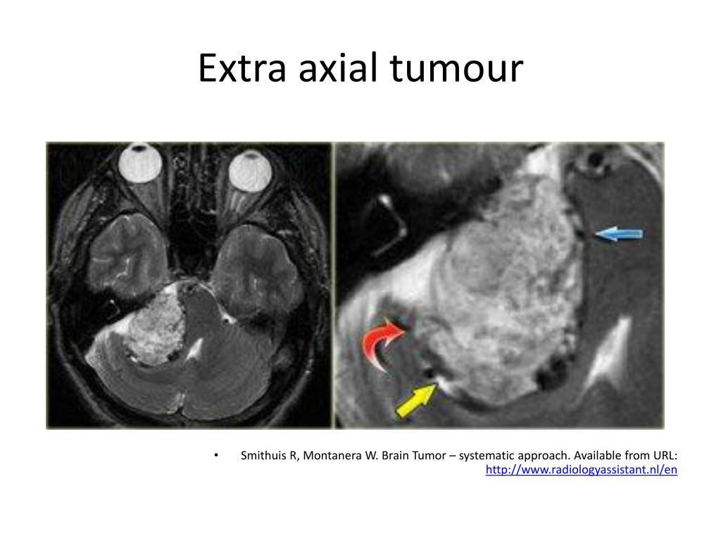 PPT - Diagnostic Imaging Approach to a Supratentorial SOL in an Adult ...