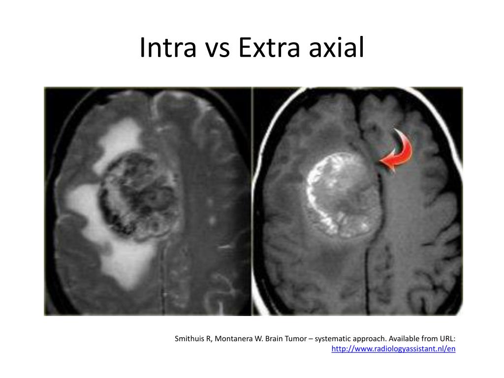 PPT - Diagnostic Imaging Approach to a Supratentorial SOL in an Adult ...