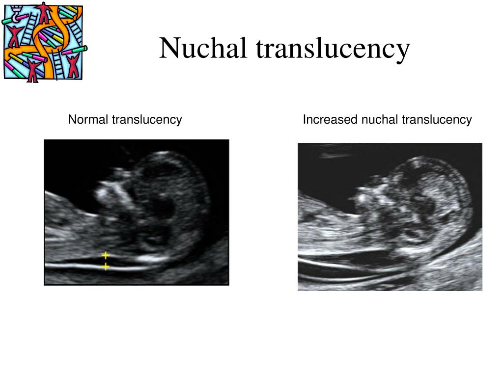 PPT - Genetics for Maternal Child Health Nursing PowerPoint ...