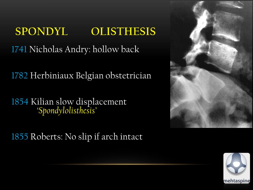 PPT - Spondylolisthesis PowerPoint Presentation, free download - ID:1562640