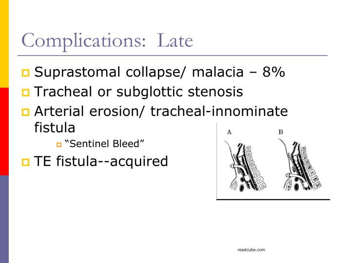 PPT - Pediatric Tracheostomy PowerPoint Presentation - ID:1567064