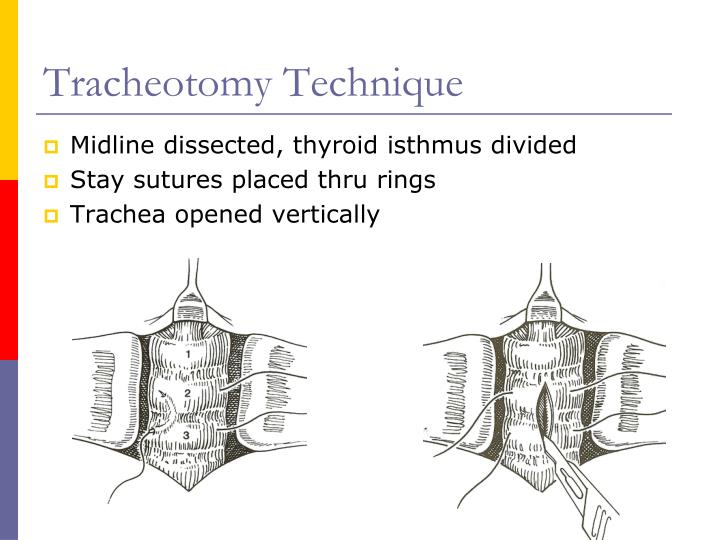 PPT - Pediatric Tracheostomy PowerPoint Presentation - ID:1567064
