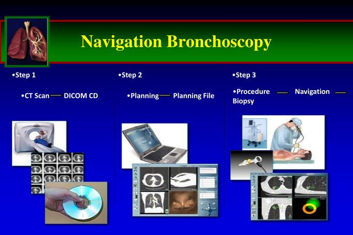 PPT - Electromagnetic Navigational Bronchoscopy versus CT-guided biopsy ...