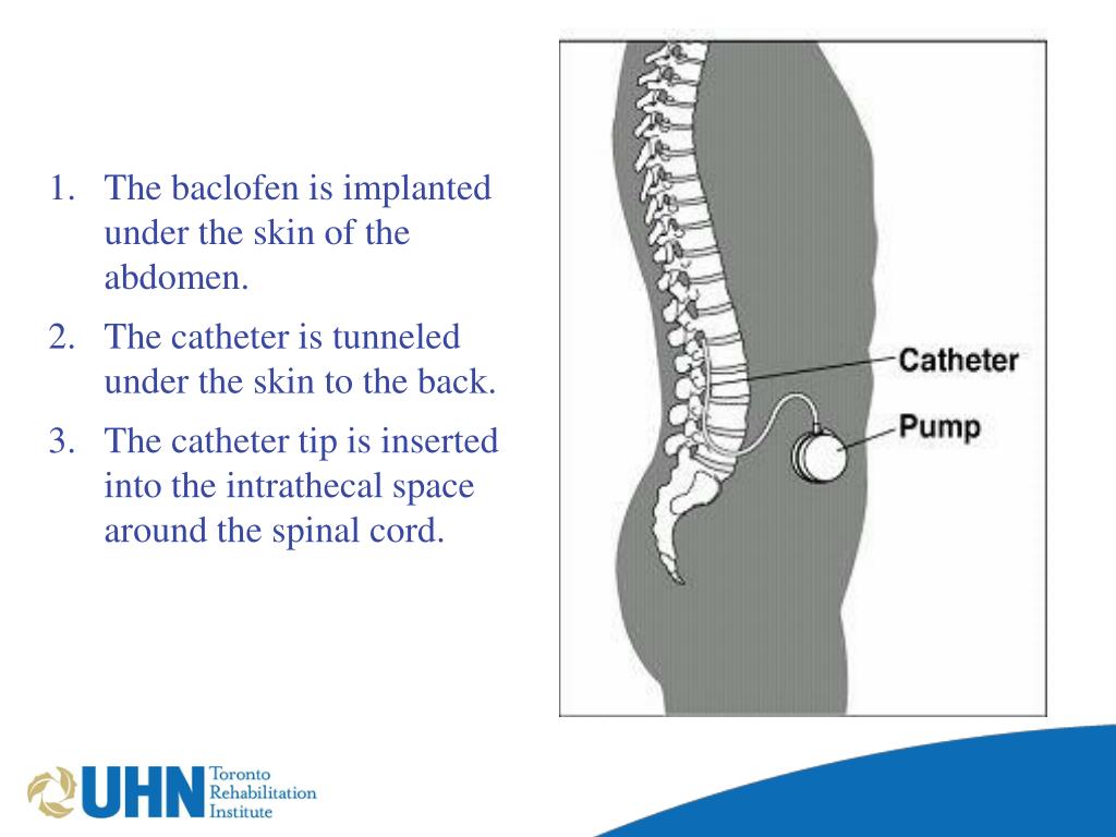 PPT - Spasticity and the Use of the Baclofen Pump for the SCI Patient ...