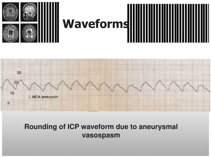 PPT - Care of the Patient with an EVD or Lumbar Drain PowerPoint ...