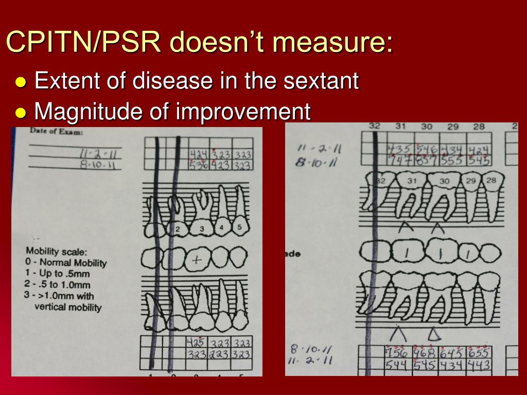 PPT - Periodontal Diagnoses and Treatment Planning PowerPoint ...