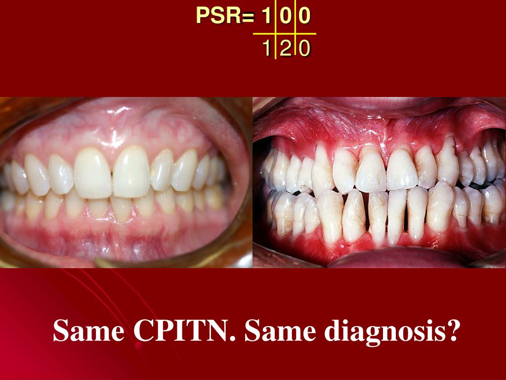 PPT - Periodontal Diagnoses and Treatment Planning PowerPoint ...