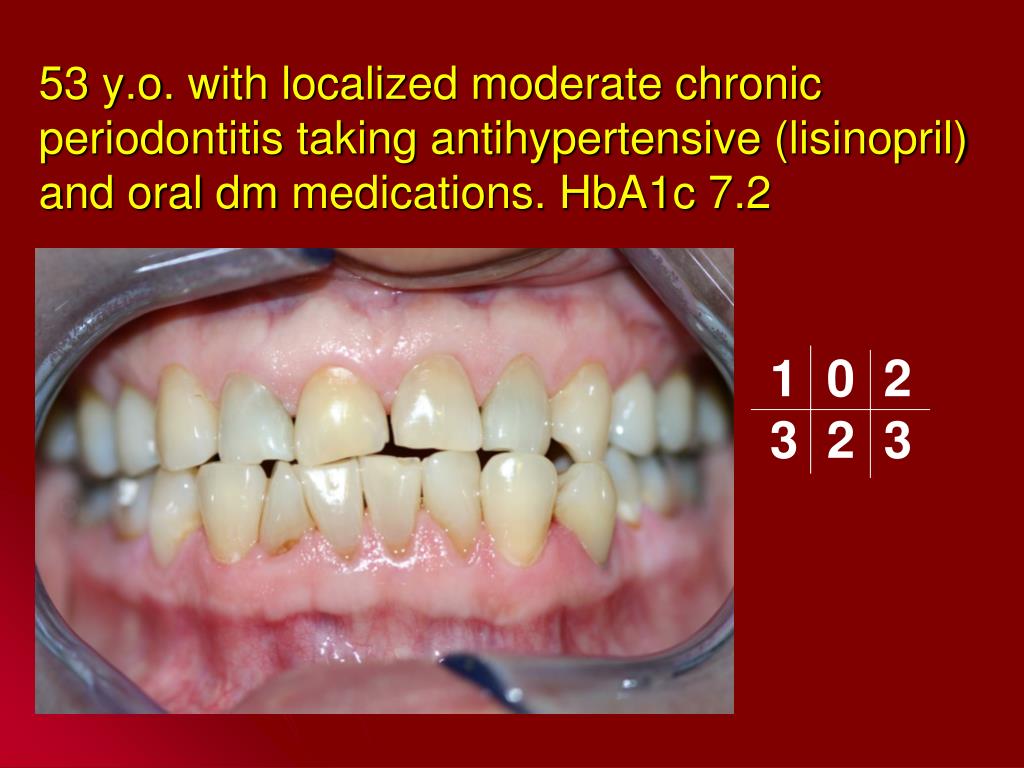 PPT - Periodontal Diagnoses and Treatment Planning PowerPoint ...