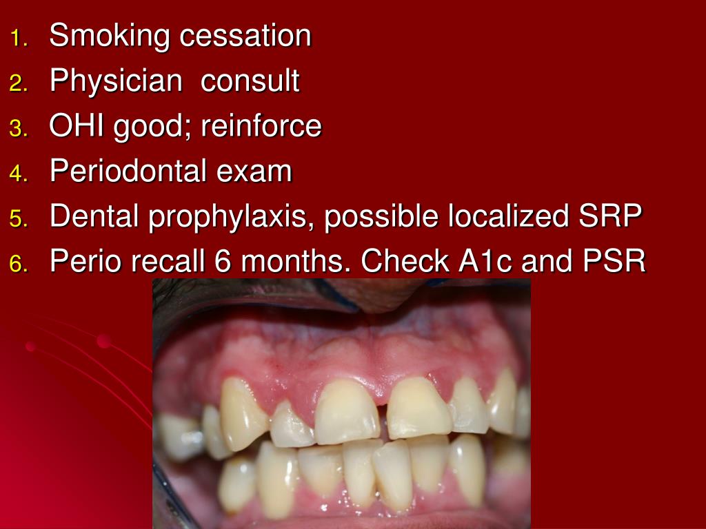 PPT - Periodontal Diagnoses and Treatment Planning PowerPoint ...