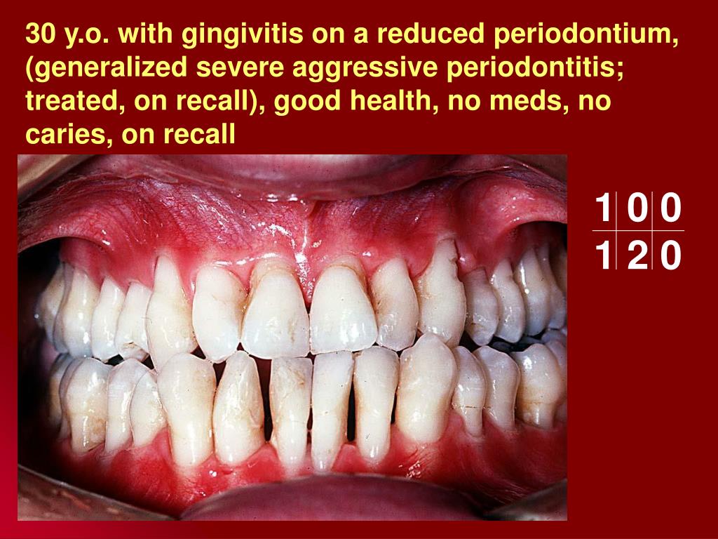 PPT - Periodontal Diagnoses and Treatment Planning PowerPoint ...