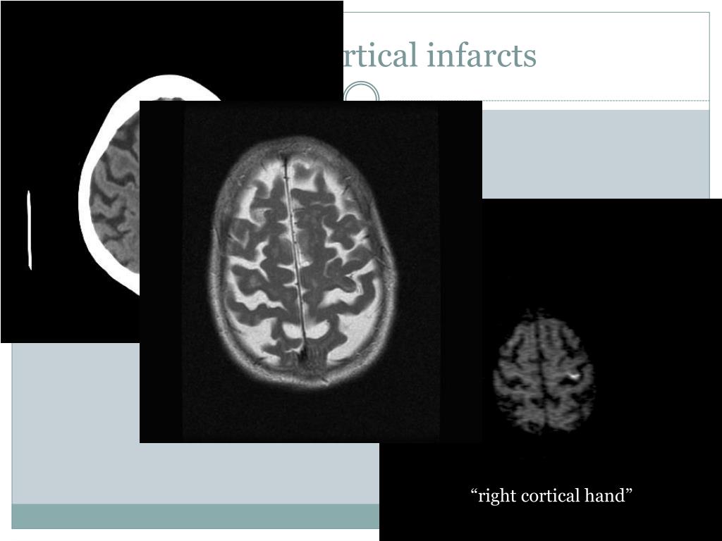 PPT - Acute stroke imaging and endovascular therapy PowerPoint ...