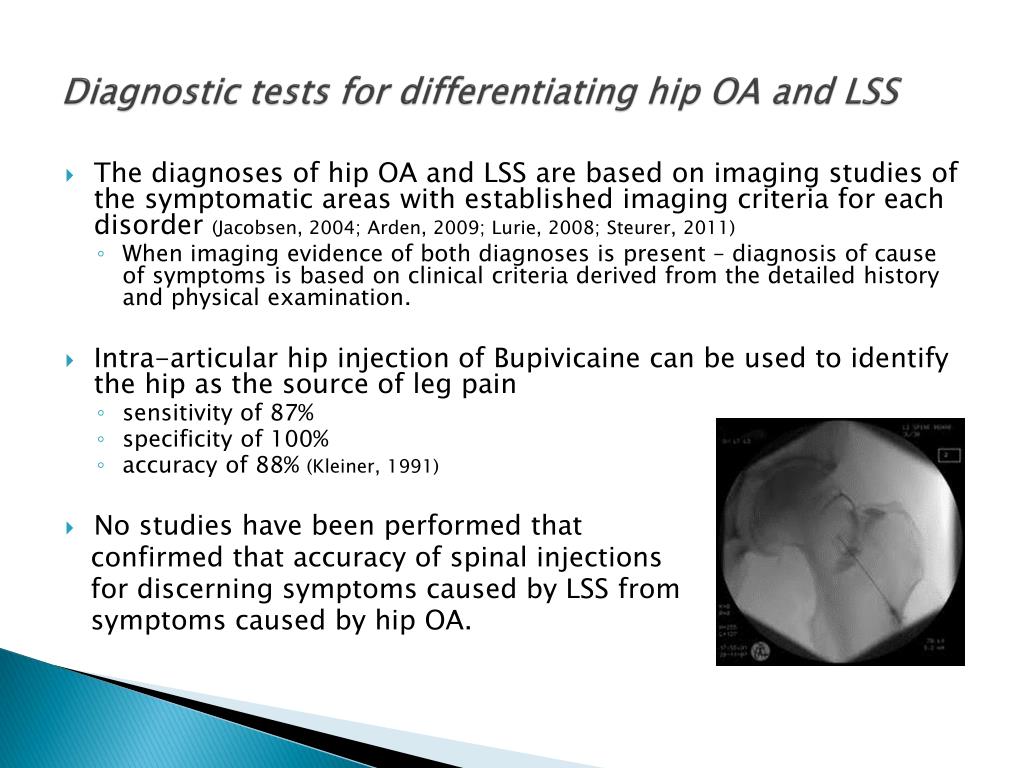 PPT - Diagnosing Leg Pain Lumbar Spinal Stenosis vs Hip Osteoarthritis ...