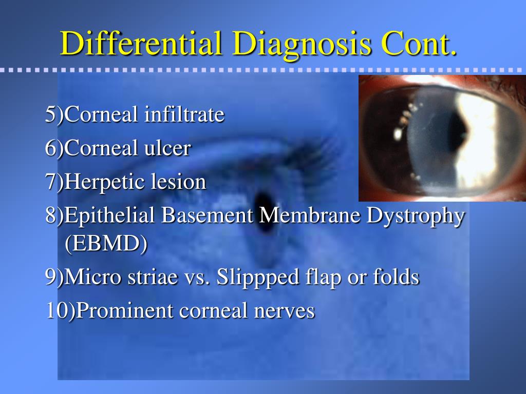 PPT - LASIK & PRK: Potential Post-op Corneal Opacities PowerPoint ...