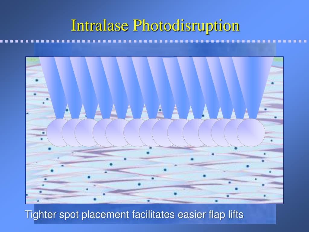 PPT - LASIK & PRK: Potential Post-op Corneal Opacities PowerPoint ...