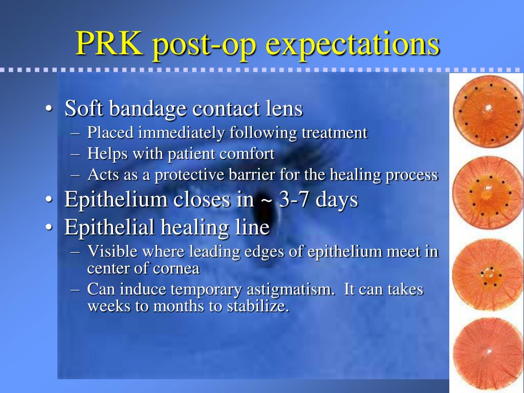 PPT - LASIK & PRK: Potential Post-op Corneal Opacities PowerPoint ...