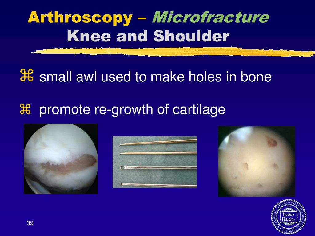 PPT - Arthritis Seminar Solutions for Knee, Shoulder and Hip PowerPoint ...