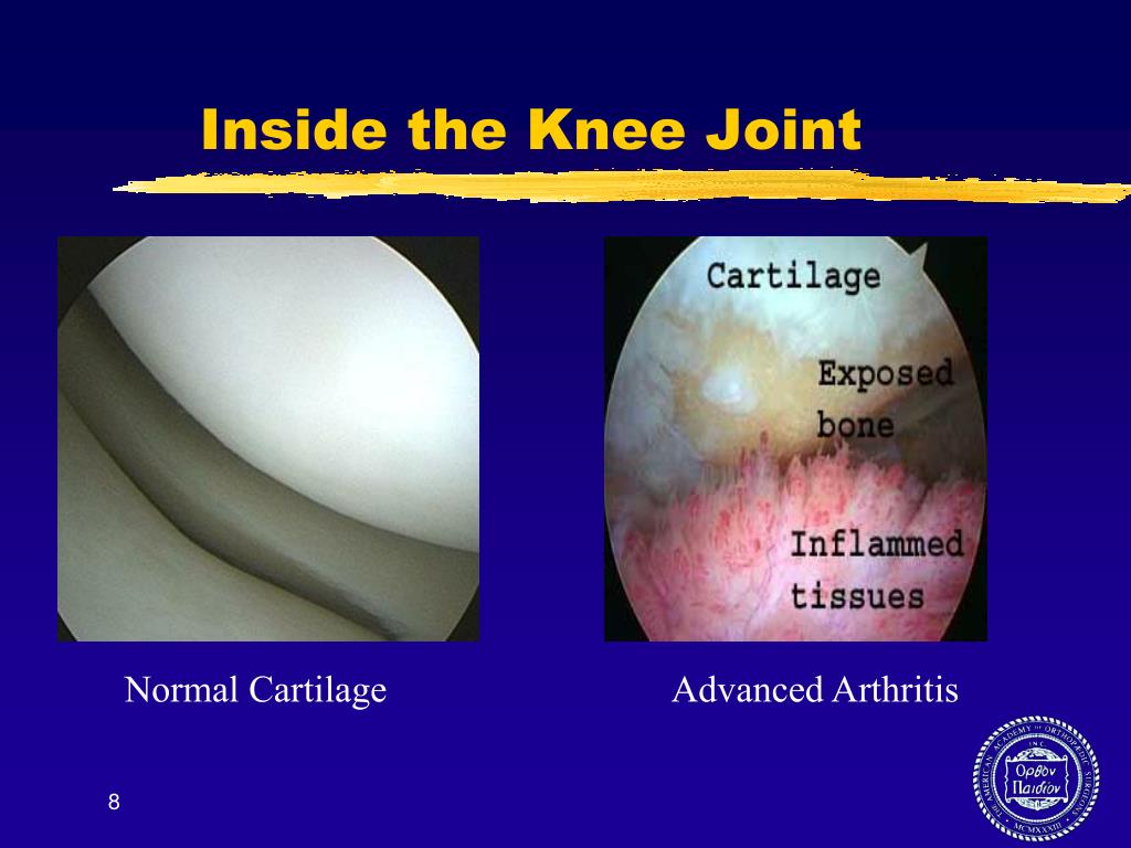 PPT - Arthritis Seminar Solutions for Knee, Shoulder and Hip PowerPoint ...