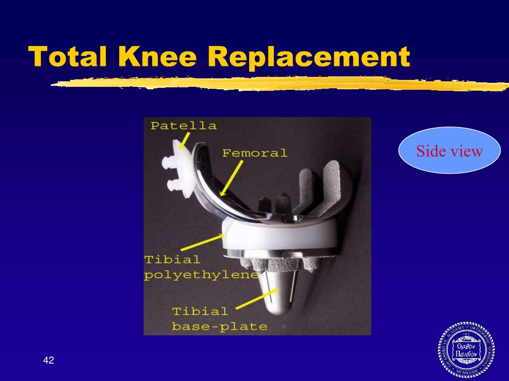 PPT - Arthritis Seminar Solutions for Knee, Shoulder and Hip PowerPoint ...