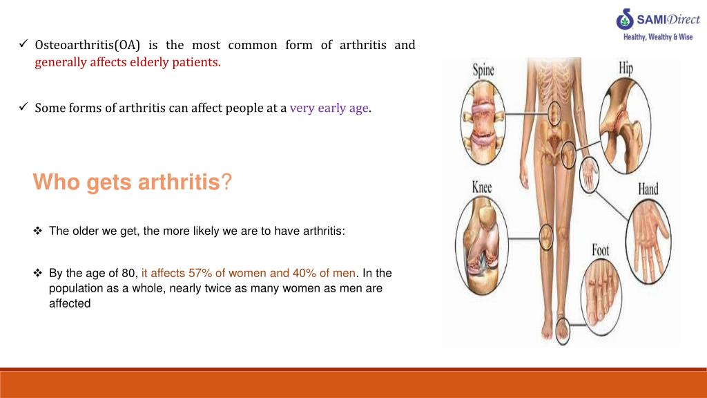PPT - Arthritis Who gets arthritis Facts About Arthritis What causes ...