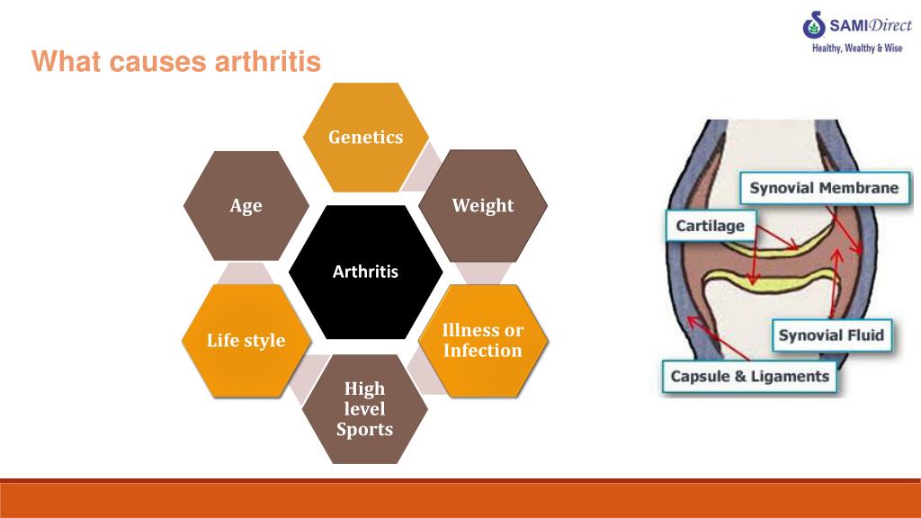 PPT - Arthritis Who gets arthritis Facts About Arthritis What causes ...