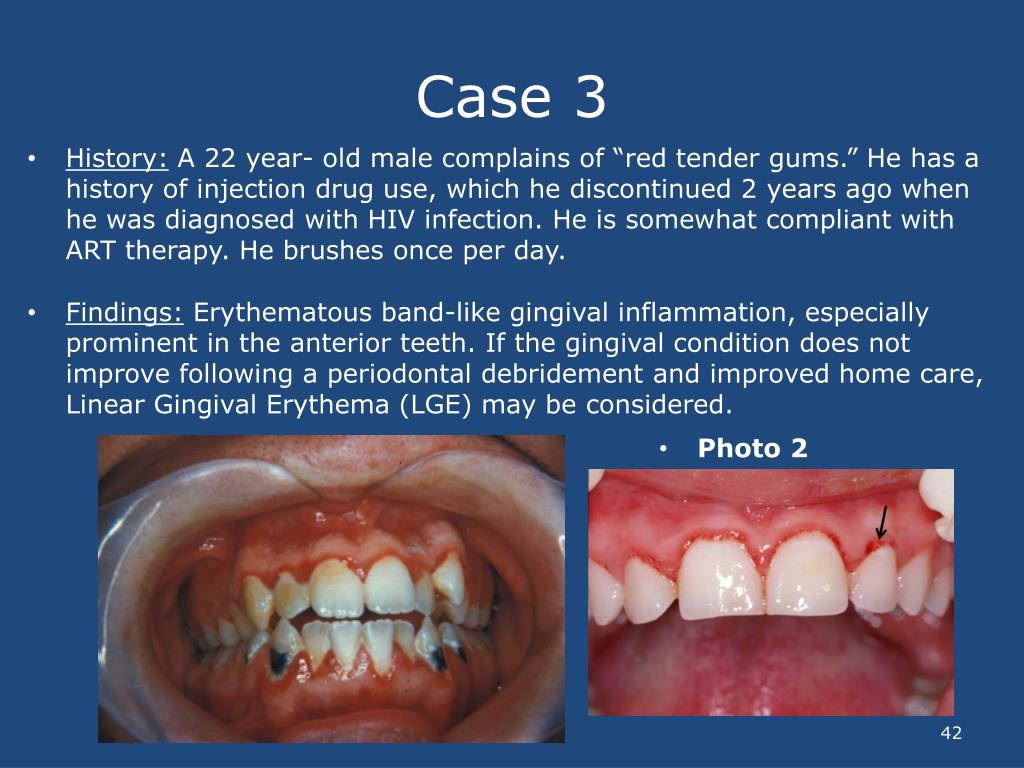 PPT - Guide to Oral Health Care for People Living with HIV/AIDS ...