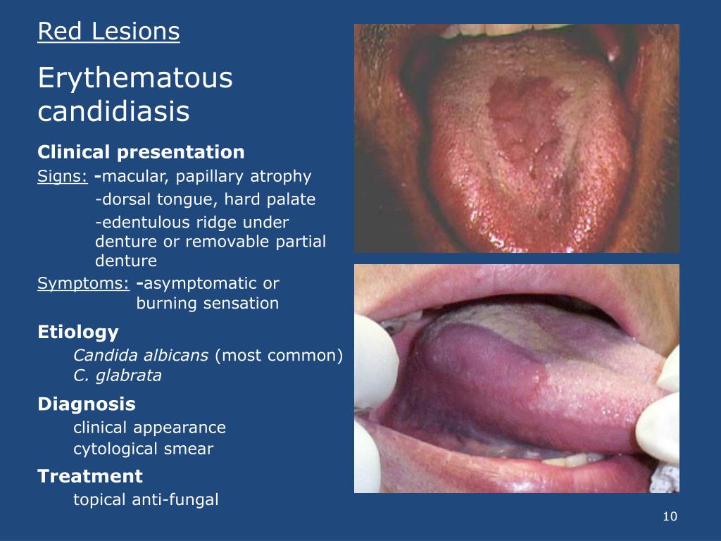 PPT - Guide to Oral Health Care for People Living with HIV/AIDS ...