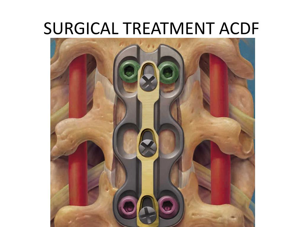 Ppt Anterior Cervical Discectomy With Fusion Acdf Powerpoint