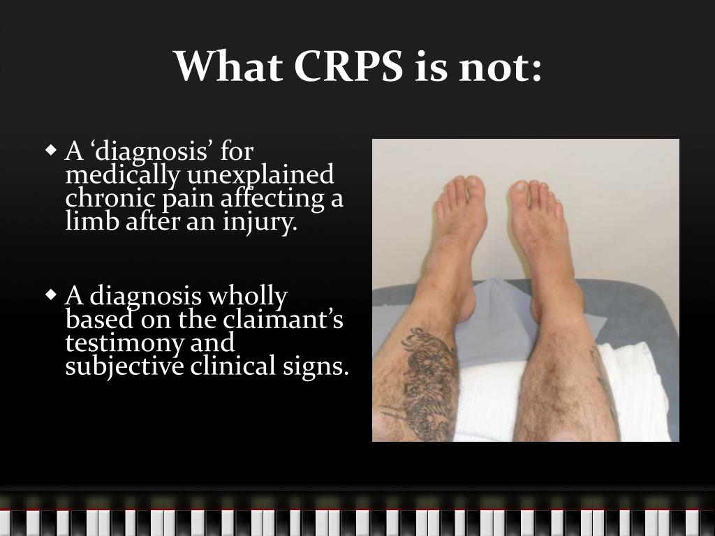PPT - Complex Regional Pain Syndrome (CRPS) - A Medicolegal Perspective ...