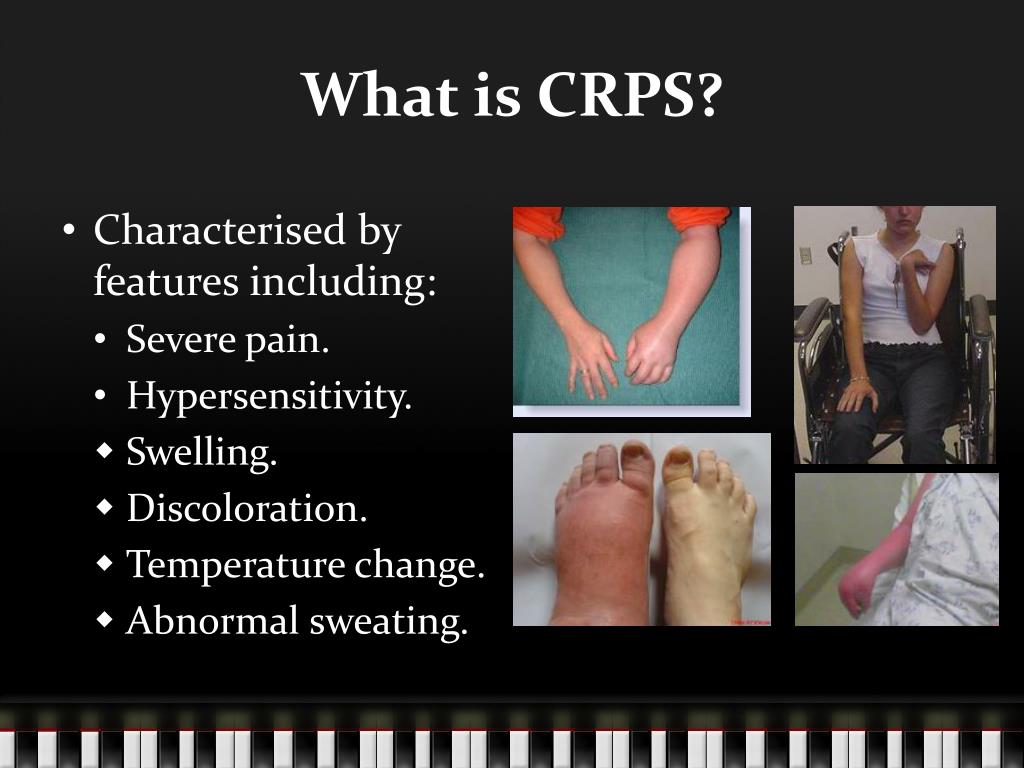 PPT - Complex Regional Pain Syndrome (CRPS) - A Medicolegal Perspective ...