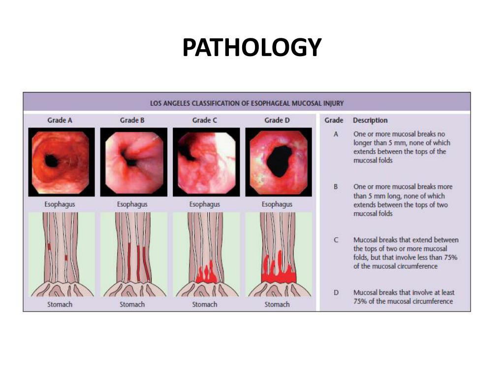 PPT - GASTROESOPHAGEAL REFLUX DISEASE PowerPoint Presentation, free ...