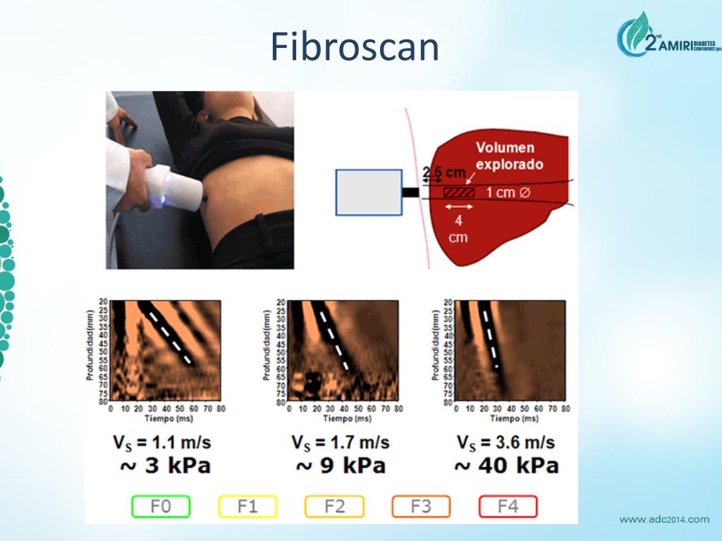 PPT - Diabetes Mellitus and Non- Alcoholic Fatty Liver Diseas ...