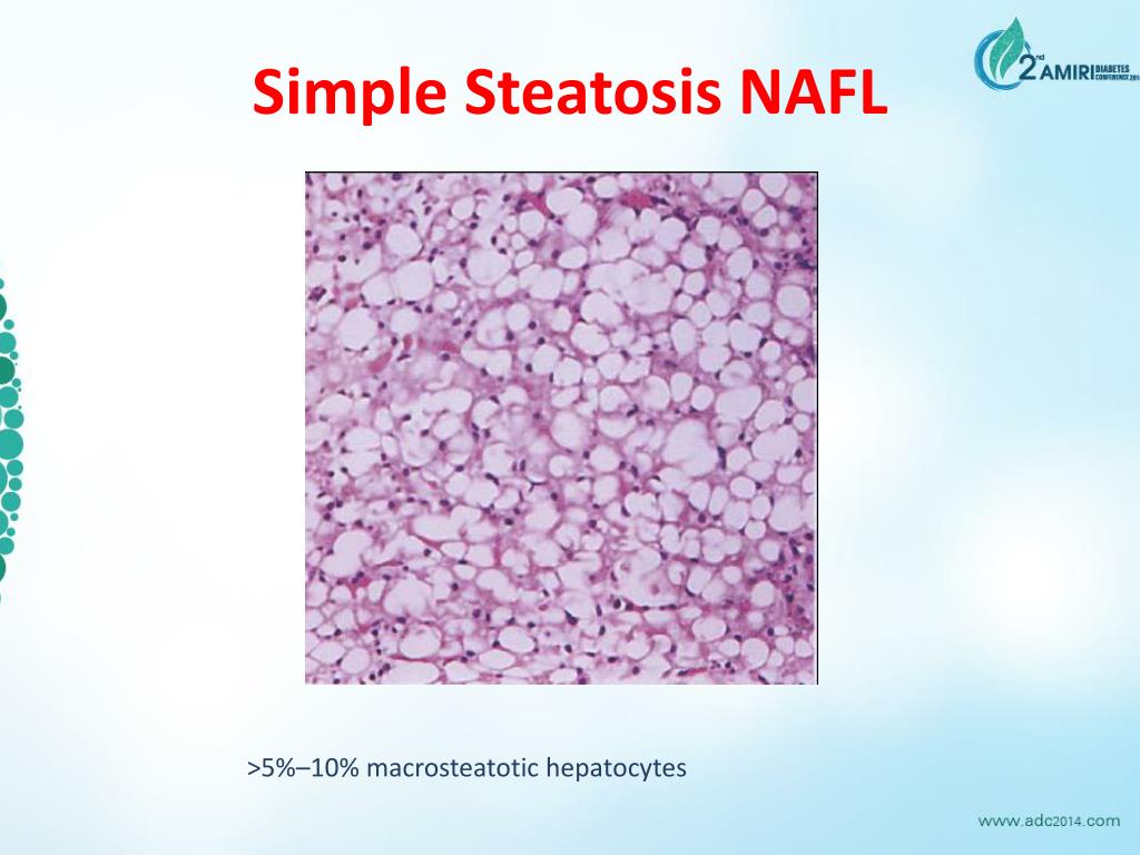 PPT - Diabetes Mellitus and Non- Alcoholic Fatty Liver Diseas ...