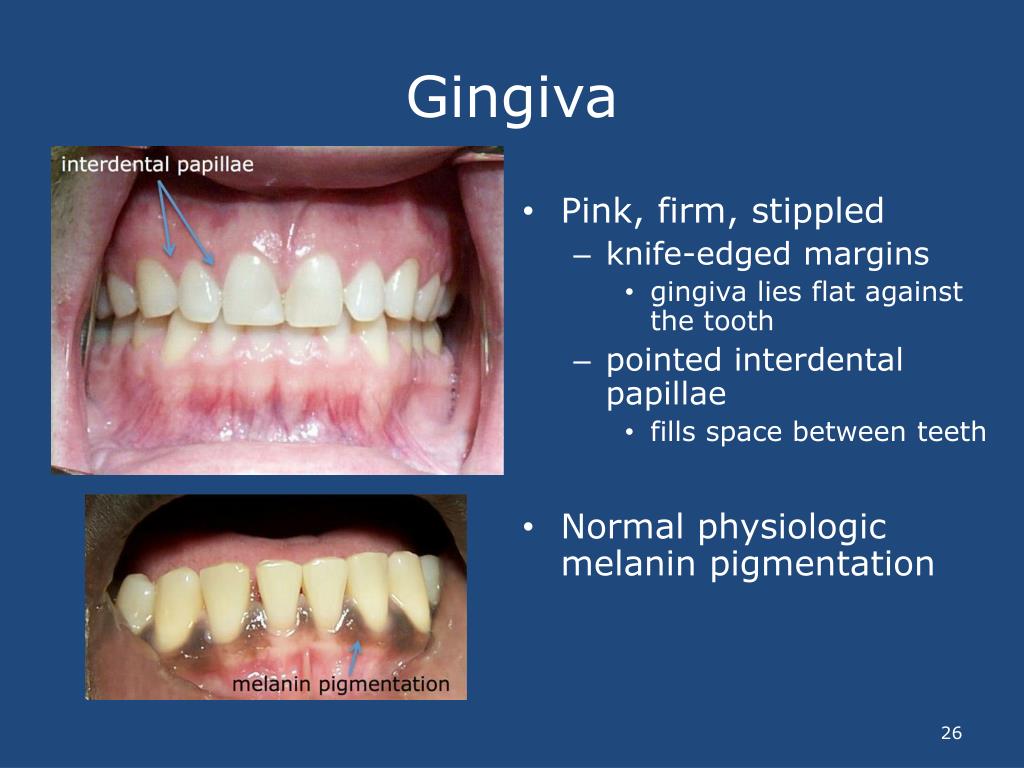 PPT - Guide to Oral Health Care for People Living with HIV/AIDS ...