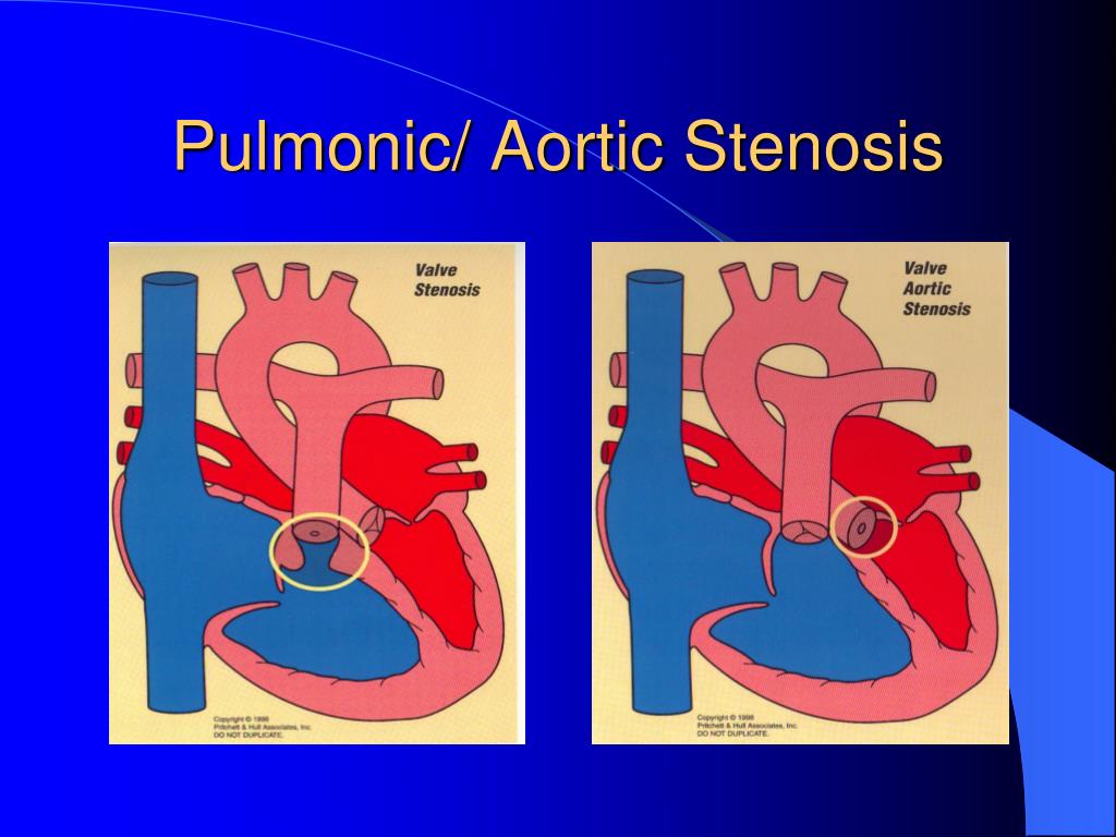 Ppt Pediatric Board Review 2013 Pediatric Cardiology Powerpoint