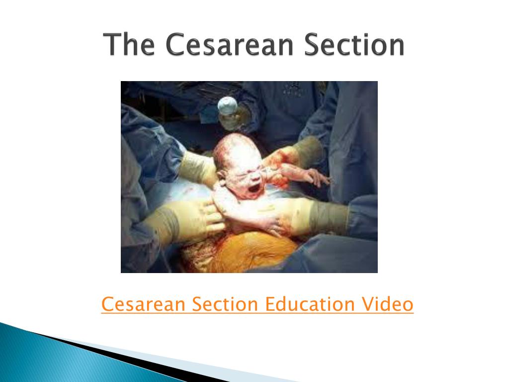 PPT - Boven Birth Center Cesarean Section Orientation PowerPoint ...