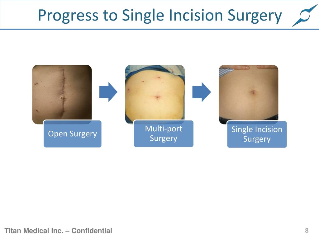 PPT - Titan Medical Inc. Single Incision Surgery TSX-V: TMD | OTCQX ...