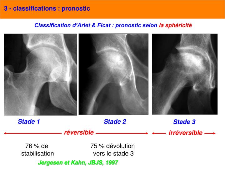 PPT - Les classifications des ostéonécroses de la tête fémorale ...