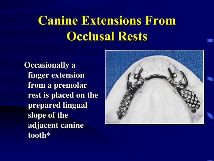 PPT - Indirect Retainers PowerPoint Presentation - ID:1700222
