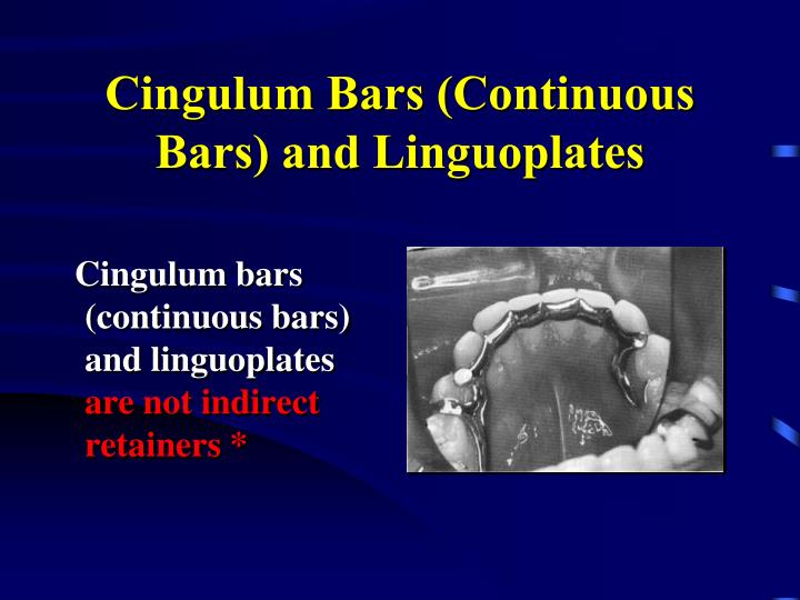 PPT - Indirect Retainers PowerPoint Presentation - ID:1700222