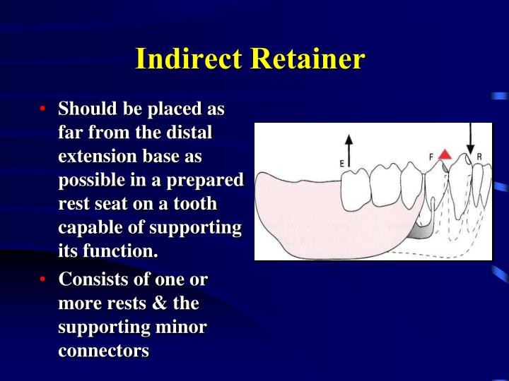 PPT - Indirect Retainers PowerPoint Presentation - ID:1700222