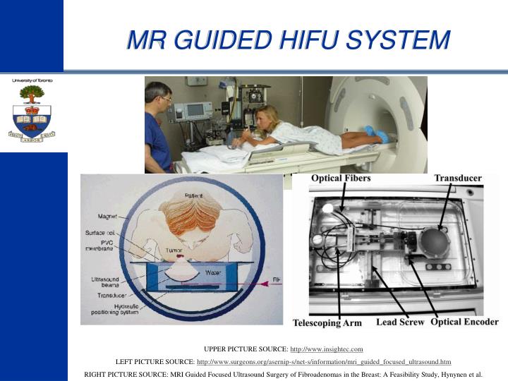 PPT - HIGH INTENSITY FOCUSED ULTRASOUND PowerPoint Presentation - ID ...
